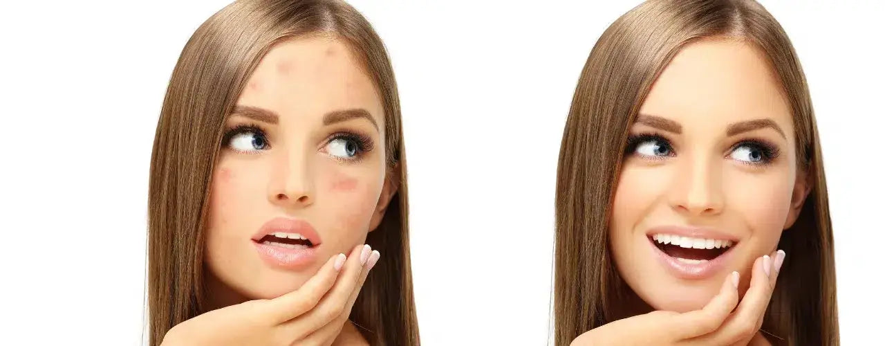 Acne's Evolution: A Stage-by-Stage Guide to Understanding and Treating ...