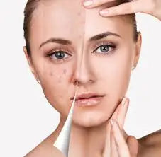 Acne Treatment: 7 Effective Ways to Clear Your Skin Fast – Derma.pk
