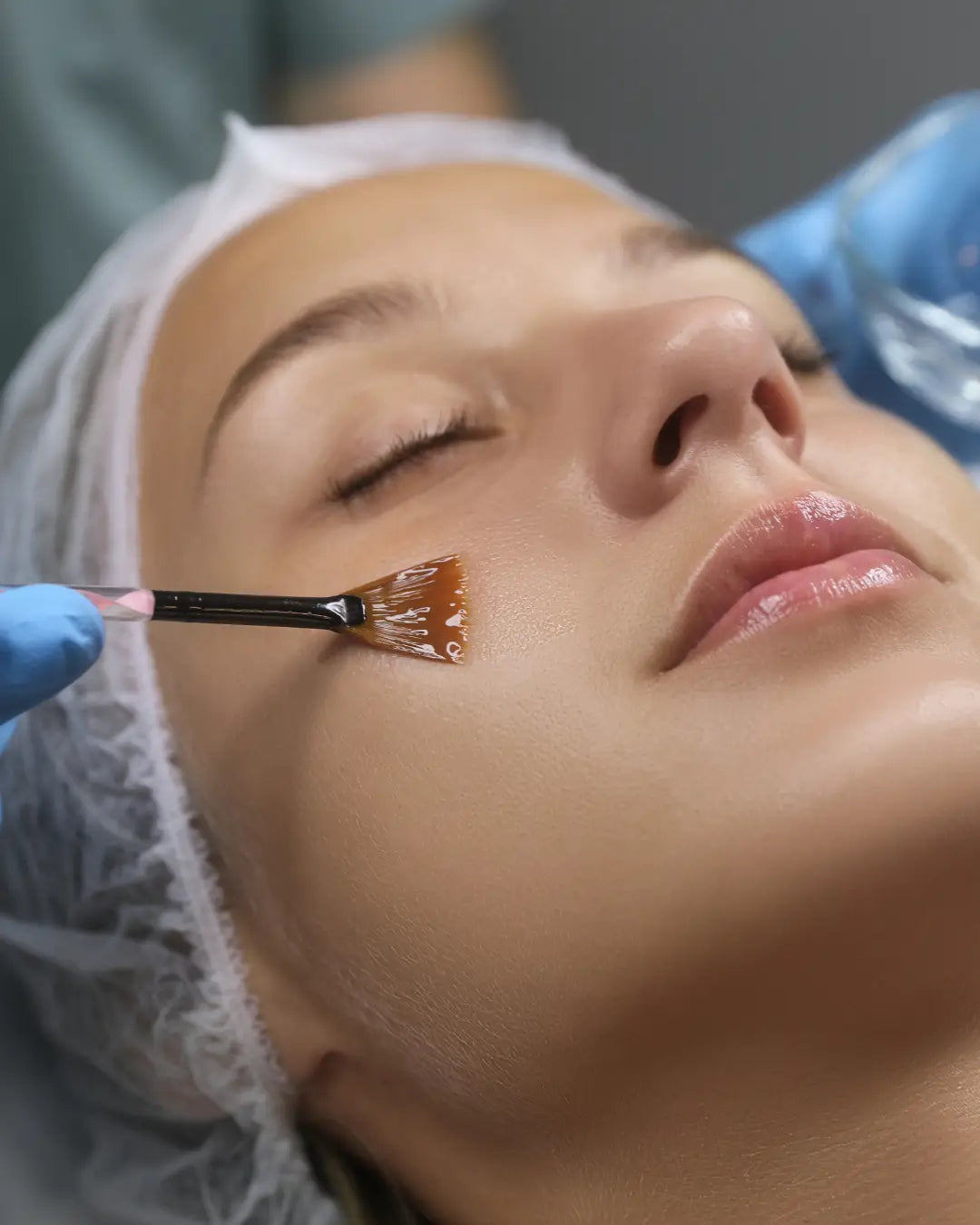 Chemical Peeling | Transform Skin, Say Goodbye to Acne & Melasma – Derma.pk