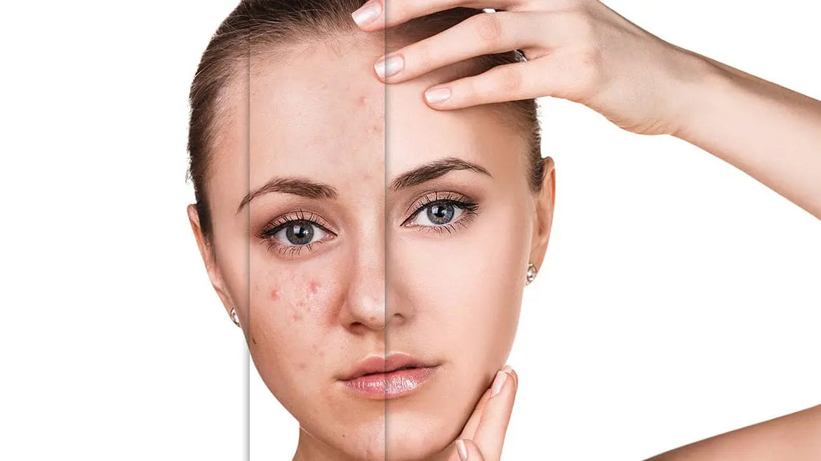 Anti Acne Treatments in Pakistan – Acne Creams, Gels & Face Washes ...