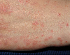 Anti Scabies treatments in Pakistan – Scabies Creams & Medications ...